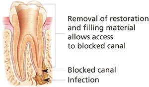Retreatment Procedures - La Jolla Endodontics - (858) 546-9299